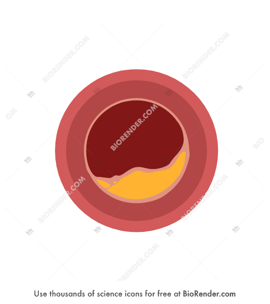 Free Atherosclerosis (cross-section, 1c. fibrous plaque) Icons, Symbols ...