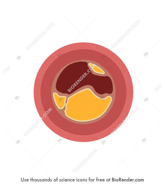 Free Atherosclerosis (cross-section, 2. fibrous plaque) Icons, Symbols ...