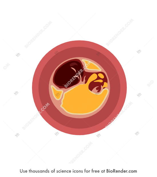Free Atherosclerosis (cross-section, 3. rupture and thrombosis) Icons ...