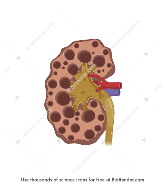 Free Kidney (polycystic, cut) Icons, Symbols & Images | BioRender