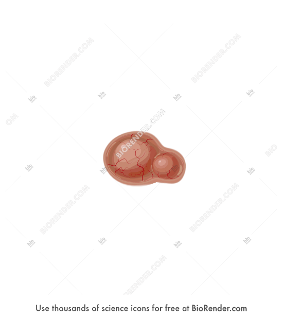 Free Basal cell carcinoma (skin cancer) Icons, Symbols & Images | BioRender