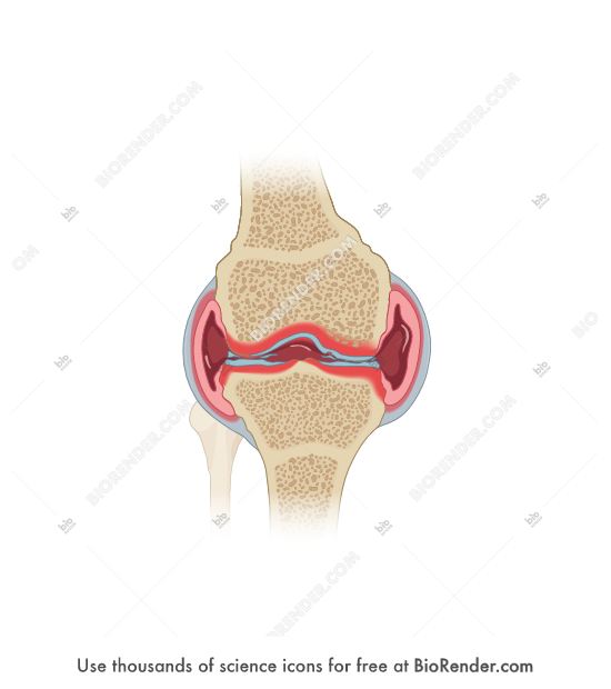 Free Knee joint (cross-section, arthritic) Icons, Symbols & Images ...