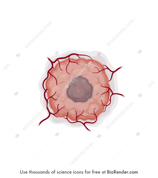 Free Tumor (glioblastoma, with blood vessels) Icons, Symbols & Images | BioRender
