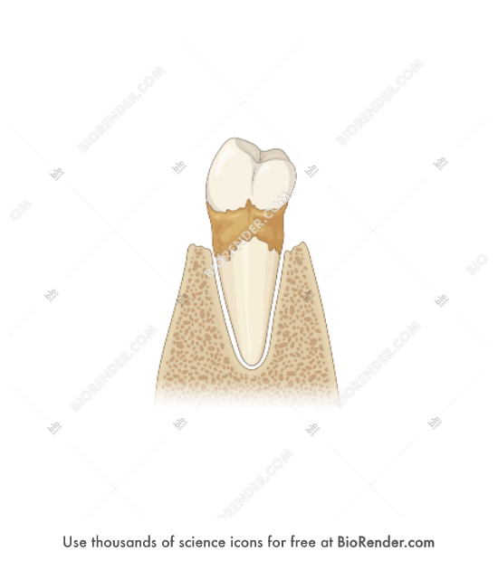 Free Tooth (premolar, periodontal disease in bone) Icons, Symbols ...