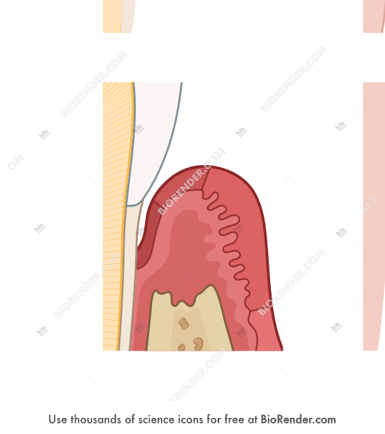 Free Gingival Epithelium (periodontal disease) Icons, Symbols & Images ...