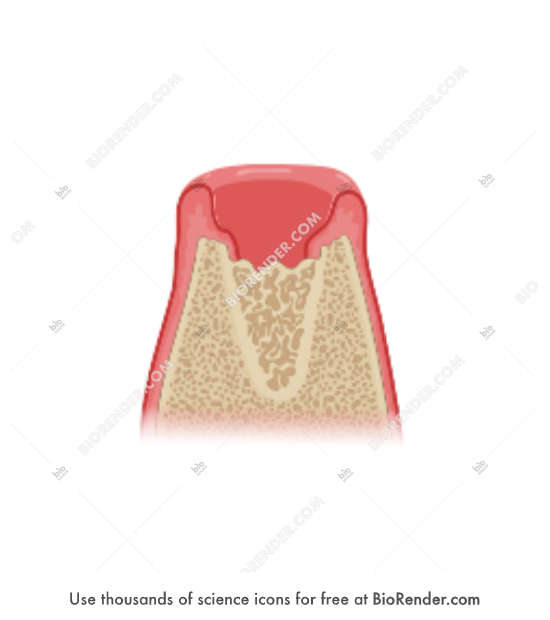 Free Tooth (premolar, woven bone with gums diseased) Icons, Symbols ...
