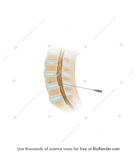 Free Lumbar puncture Icons, Symbols & Images | BioRender