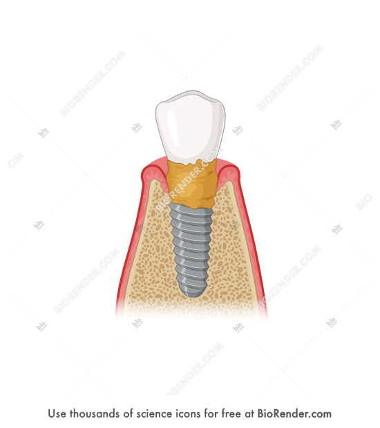 Free Peri-implantitis Icons, Symbols & Images | BioRender
