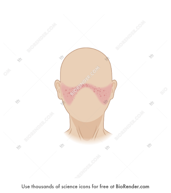 Free Malar rash (female) Icons, Symbols & Images | BioRender