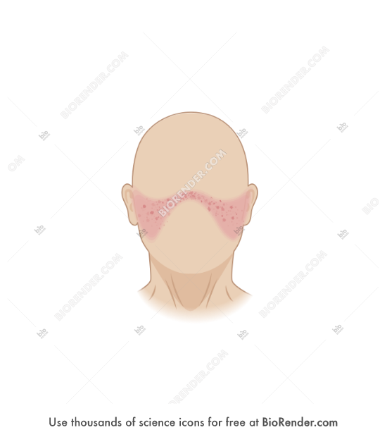 Free Malar rash (male) Icons, Symbols & Images | BioRender