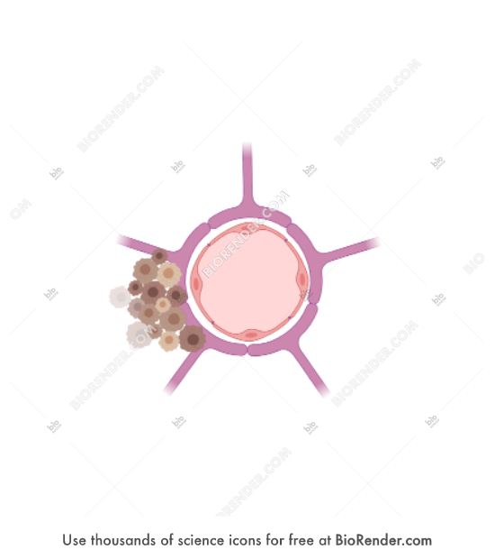 Free Blood brain barrier (cross-section, with metastasizing tumor ...