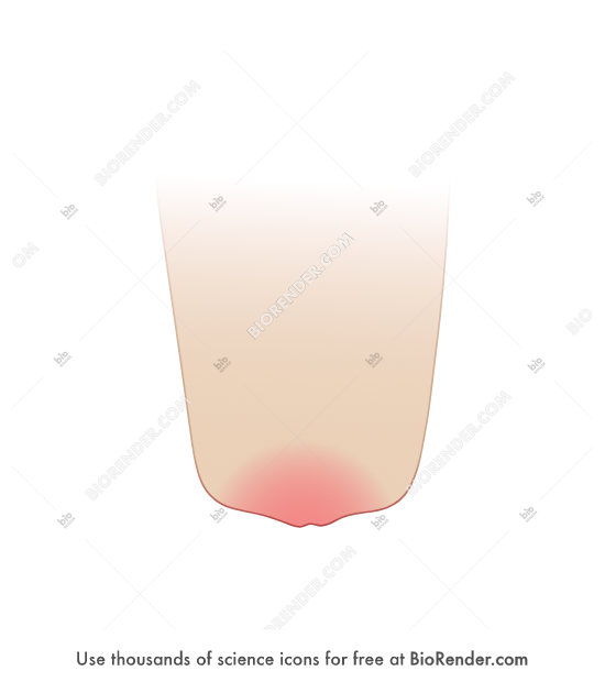 Free Limb (amputation stump, infected) Icons, Symbols & Images | BioRender