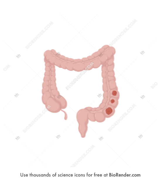 Free Colon with tumors Icons, Symbols & Images | BioRender