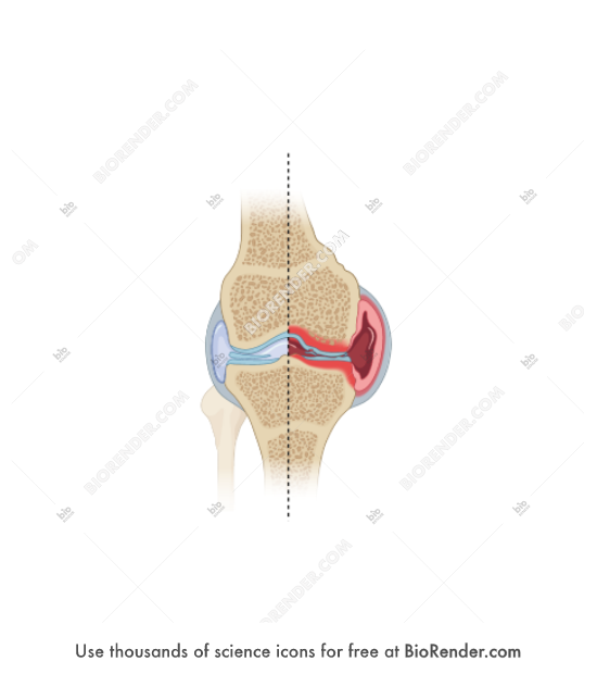 Free Knee joint (cross section, healthy, arthritic comparison) Icons ...
