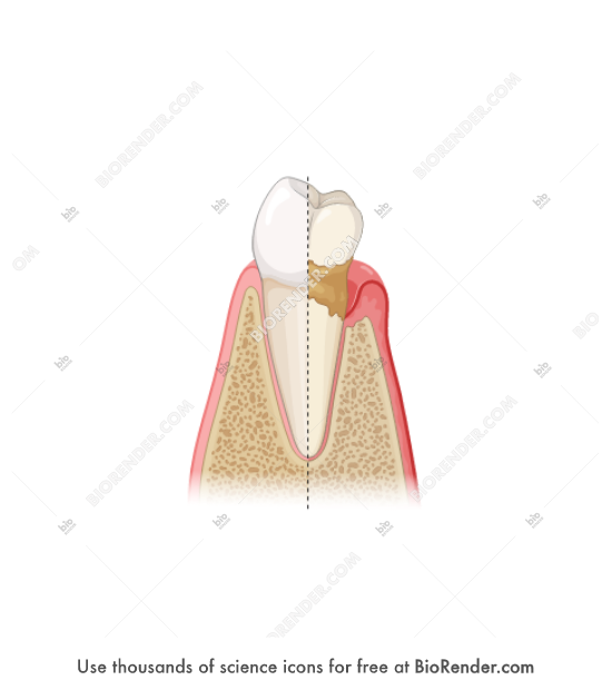 Free Tooth (premolar, periodontitis vs healthy) Icons, Symbols & Images ...
