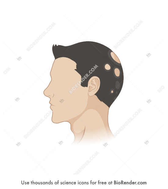 Free Male head (with Alopecia areata) Icons, Symbols & Images | BioRender
