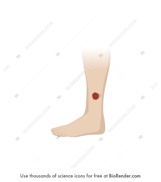 Free Lower leg (lateral with chronic wound) Icons, Symbols & Images ...