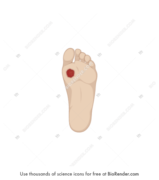 Free Foot (sole with chronic wound) Icons, Symbols & Images | BioRender