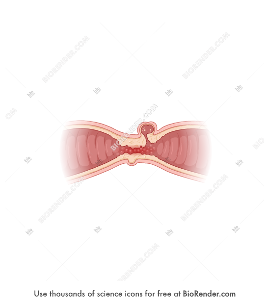 Free Intestinal stenosis Icons, Symbols & Images | BioRender