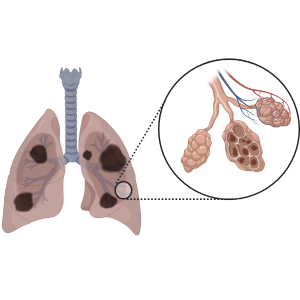 Free Lungs (diseased with alveoli callout) Icons, Symbols & Images ...