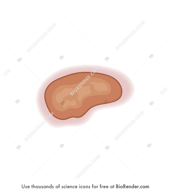 Free Ulcer (Behcet 1) Icons, Symbols & Images | BioRender