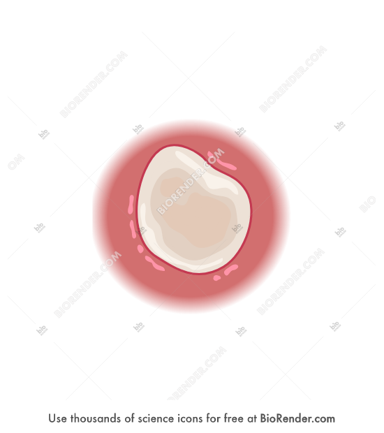 Free Ulcer (shape 2) Icons, Symbols & Images | BioRender
