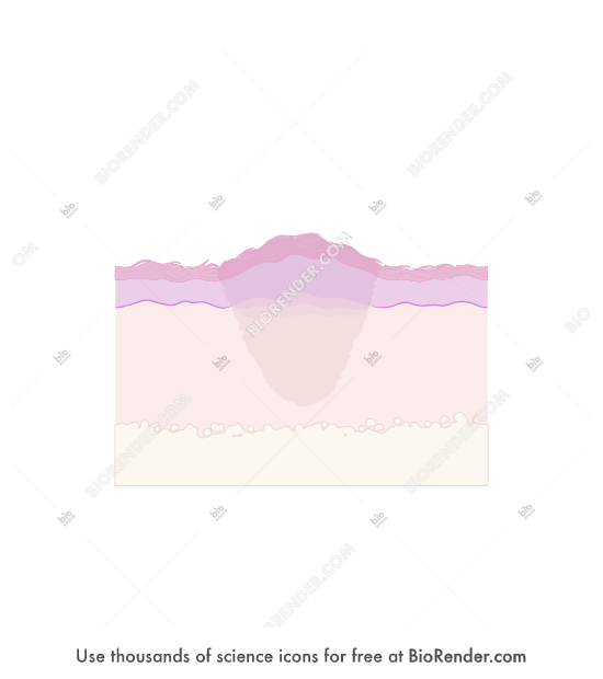Free Skin epithelium (hypertrophic scar) Icons, Symbols & Images ...
