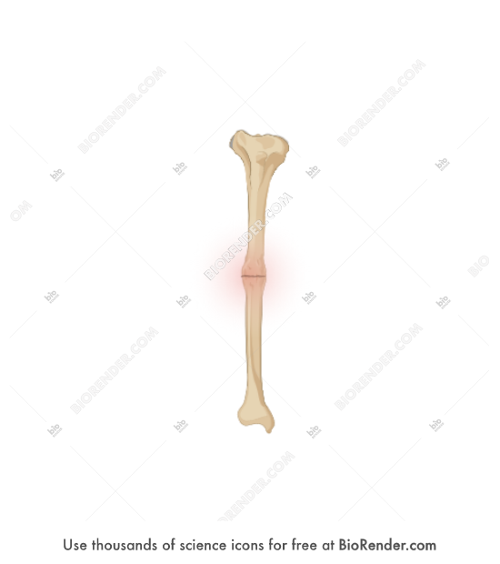 Free Healing bone fracture in tibia Icons, Symbols & Images | BioRender