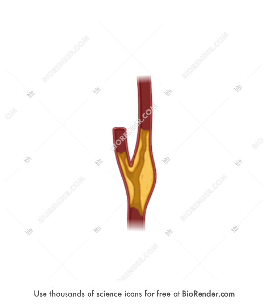 Free Carotid body (with plaque) Icons, Symbols & Images | BioRender