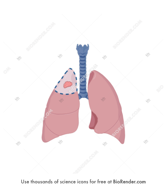 Free Lung cancer surgery (segmental resection) Icons, Symbols & Images ...