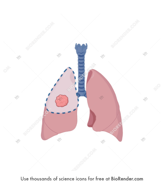 Free Lung cancer surgery (lobectomy) Icons, Symbols & Images | BioRender
