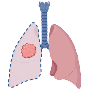 Free Lungs (pleural effusion) Icons, Symbols & Images | BioRender