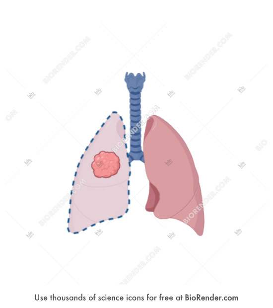 Free Lung cancer surgery (Pneumonectomy) Icons, Symbols & Images ...
