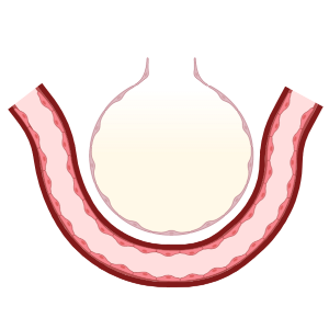 Alveoli with pneumonia | Editable Science Icons from BioRender