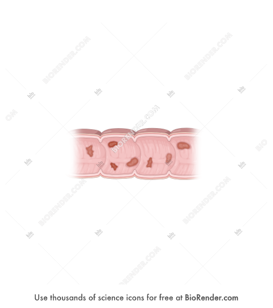 Free Large intestine (with ulcers) Icons, Symbols & Images | BioRender