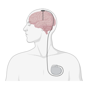 Free Deep brain stimulation Icons, Symbols & Images | BioRender