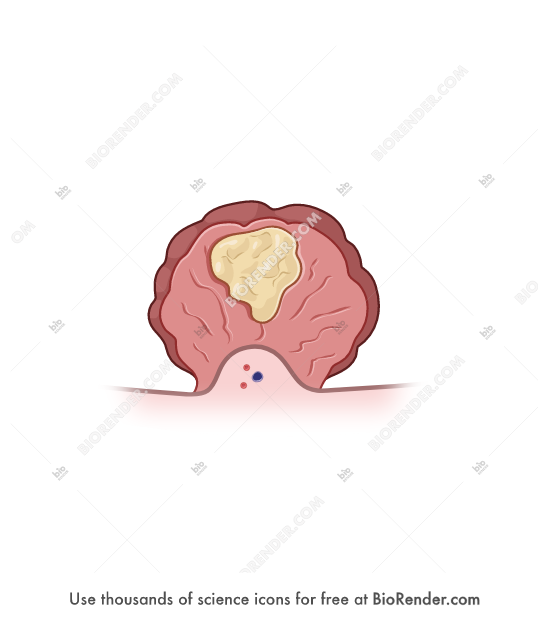Free Colon cancer (2. precancerous) Icons, Symbols & Images | BioRender