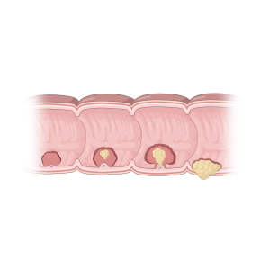 Free Stool (lienteric diarrhea) Icons, Symbols & Images | BioRender