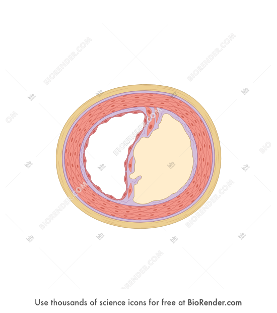 Free Atherosclerosis (molecular cross-section, 2. fibrous plaque) Icons ... Free Atherosclerosis (molecular cross-section, 2. fibrous plaque) Icons ...