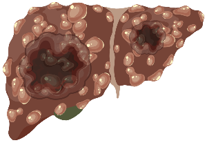 Free Stool (lienteric diarrhea) Icons, Symbols & Images | BioRender