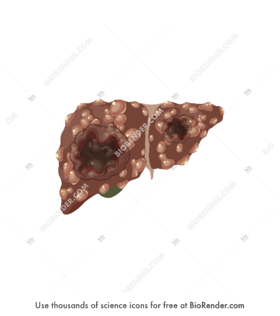 Free Liver (hepatocellular carcinoma) Icons, Symbols & Images | BioRender
