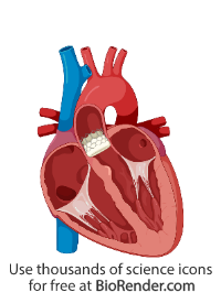 Free Heart (myocardial infarction) Icons, Symbols & Images | BioRender