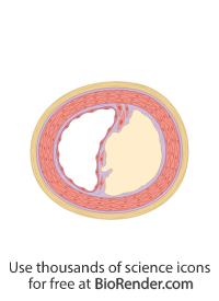 Free Atherosclerosis (molecular cross-section, 2. fibrous plaque) Icons ...