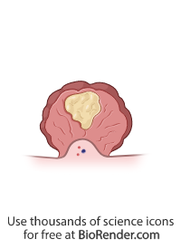 Free Colon cancer (2. precancerous) Icons, Symbols & Images | BioRender