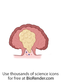 Free Colon cancer (3. adenocarcinoma) Icons, Symbols & Images | BioRender