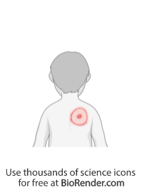 Free Erythema migrans rash (on child) Icons, Symbols & Images | BioRender