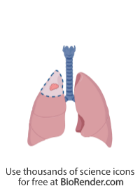 Free Lung cancer surgery (segmental resection) Icons, Symbols & Images ...