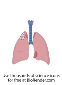 Free Lung cancer surgery (wedge resection) Icons, Symbols & Images ...