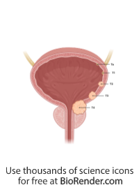 Free Bladder cancer stages (TNM classification) Icons, Symbols & Images ...