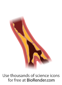 Free Atherosclerosis (with hypoxia) Icons, Symbols & Images | BioRender